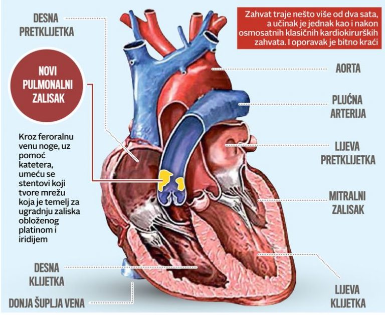 Revolucionarna metoda liječenja srca: Prvi put 'kroz nogu' uspješno ...