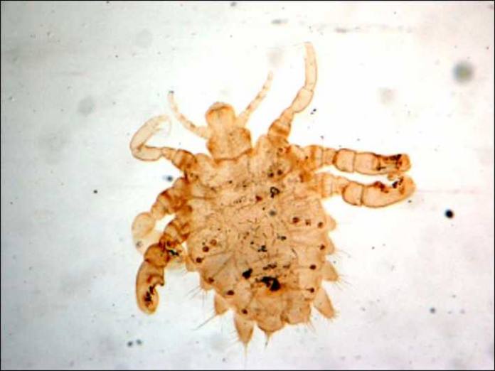 Spolna bolest: Pediculosis pubis ('stidne uši') – Hercegovina.in